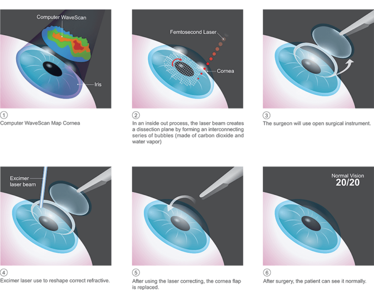 LASIK Milwaukee | LASIK Eye Surgery Mequon | Vision Correction Francis
